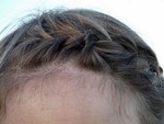 Bleach Burn on Scalp [Treatment for Irritation, Blisters, Scabs]