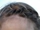 Bleach Burn on Scalp [Treatment for Irritation, Blisters, Scabs]